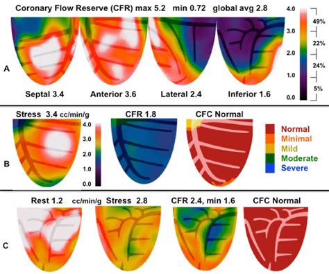 Global Perfusion Measurements Fail To Account For Severe Regional