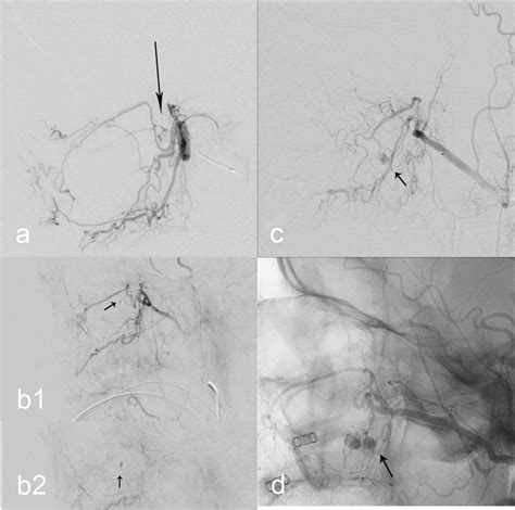 Focal Target Lesion Identification Of Focal Target Lesions Is Uncommon Download Scientific