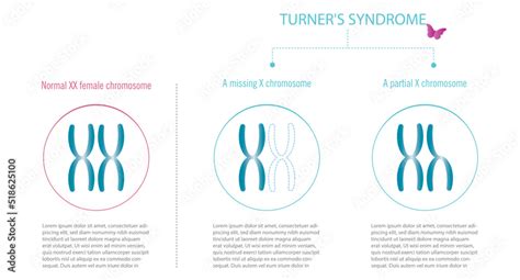 Turner Syndrome Number Of Chromosomes At Gloria Vincent Blog