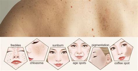 Hyperpigmentation Top Trend Beauty Clinic