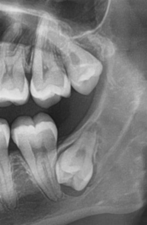 My Tooth Is Leaving Rmypeopleneedme