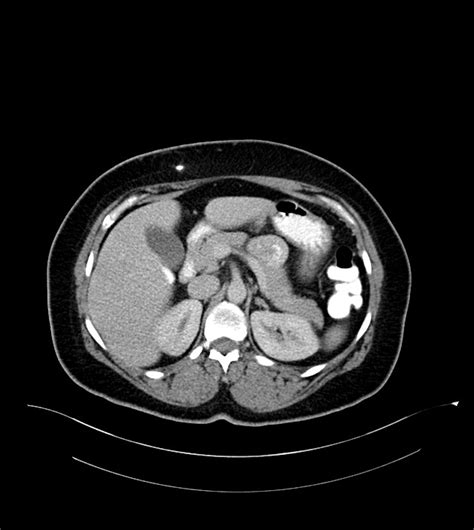 Anterior Abdominal Wall Csf Pseudocyst Csfoma Radiopaedia 79453