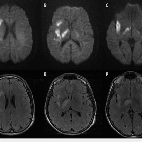DSA Study From Patient 1 Panels A B DSA Scan A And Reconstruction Download Scientific