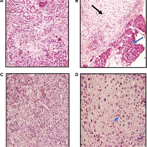 A Diffuse Infiltration Of The Tumor Cells With Almost No Tubular Download Scientific Diagram