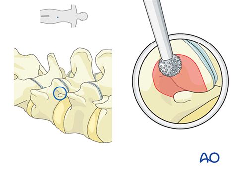Extraforaminal Endoscopic Lumbar Discectomy Eeld For Lumbar Disc