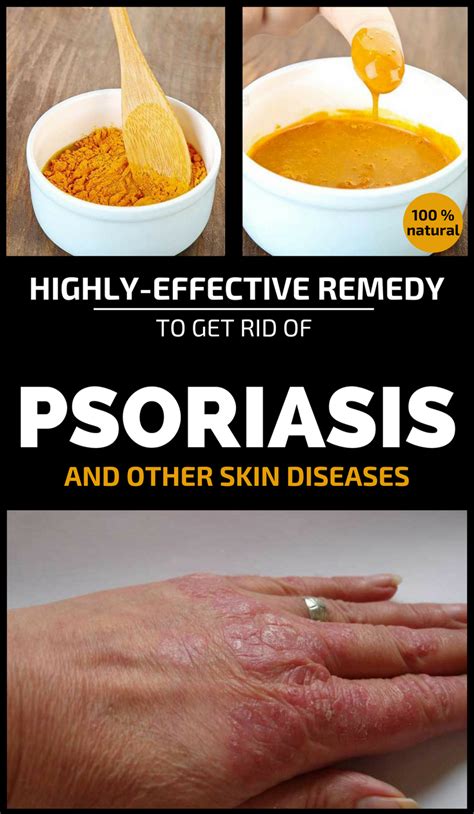 Psoriasis Remedies How To Get Rid Of It Naturally Healthmgz