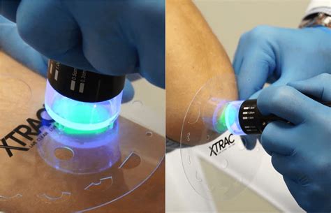Laser Treatment For Psoriasis In Mercer County Board Certified