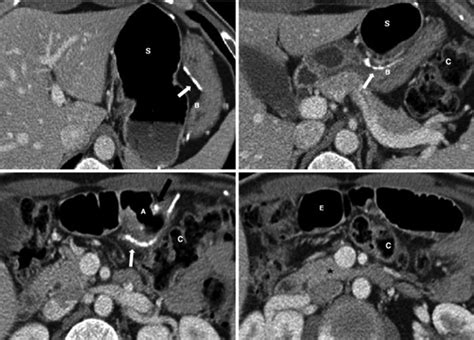 Normal Appearance In A Patient Post Mini Gastric Bypass From Cranial To
