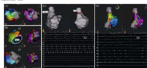 Figure From Automated UltraHigh Density Mapping In Atrial Fibrillation Hybrid Procedure
