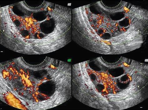Growth Rates Of Ovarian Follicles During Natural Menstrual 54 Off