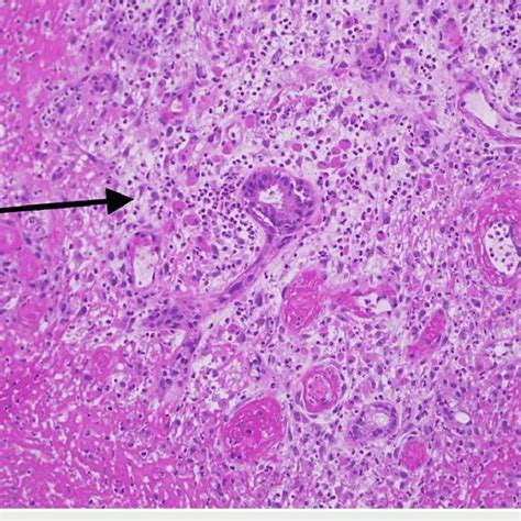 Markedly Inflamed And Ulcerated Granulation Tissue On Hematoxylin And Markedly Inflamed And Ulcerated Granulation Tissue On Hematoxylin And