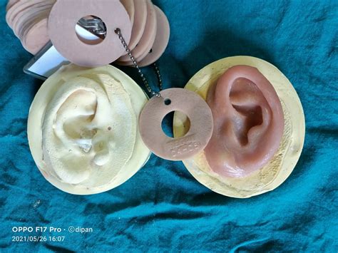 Cosmetic Silicone Ear Prosthesis Adhesive Prostheses At ₹ 15000 In