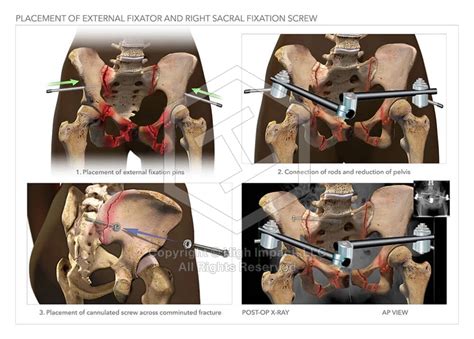 Placement Of External Fixator And Right Sacral Fixation Screw High Impact Llc