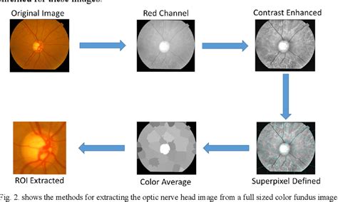 Figure 2 From Rapid Classification Of Glaucomatous Fundus Images