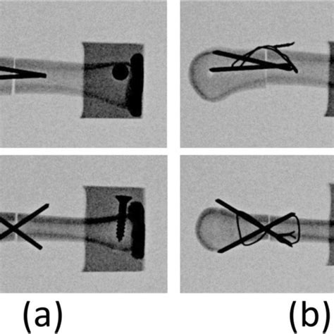 Artificial Metacarpal Bones With Transverse Shaft Fracture Subjected To Download Scientific