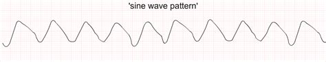 Sine Wave Ecg Pattern
