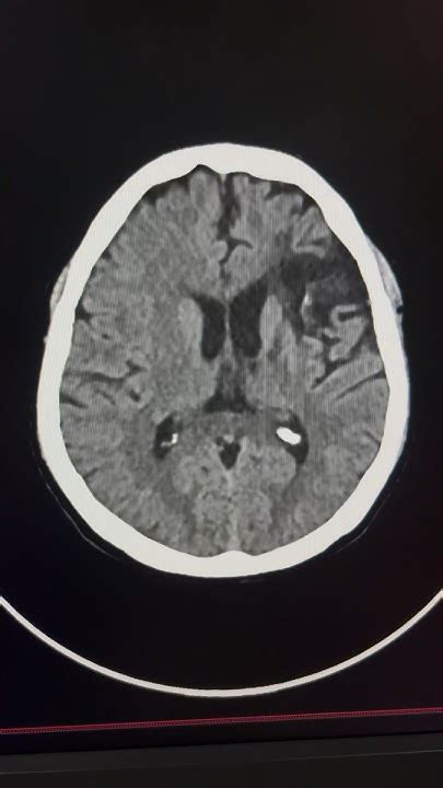 😱chronic Infarct Patientct Brainradiology Viral Ct Ctbrain