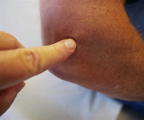 Tennis Elbow Lateral Epicondylitis Comprehensive Orthopaedics