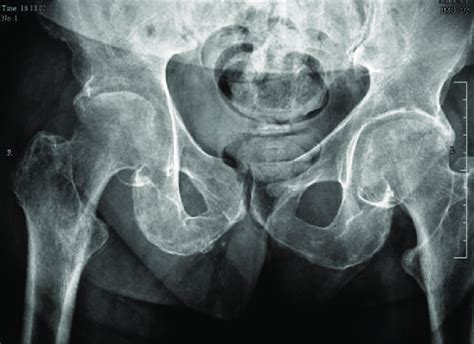 Anteroposterior Radiograph Of Pelvis Showing Narrowing Of Joint Space Download Scientific