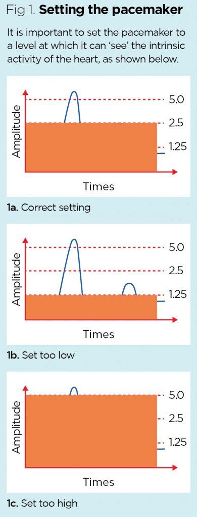 Pacemaker Therapy 2 Pacing Functions And Their Role In Patient Care