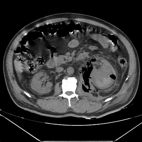 Emphysematous Pyelonephritis