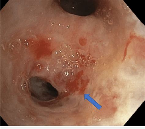 Bronchoscope Imaging Showing Narrowing Of The Segmental Bronchus And Download Scientific Bronchoscope Imaging Showing Narrowing Of The Segmental Bronchus And Download Scientific