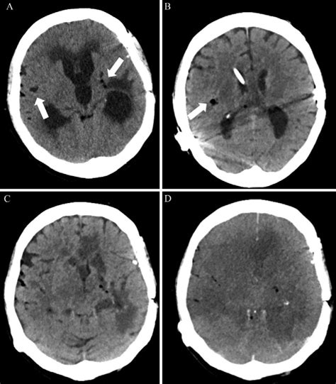 A An Axial Ct Scan On Admission Showed Hydrocephalus And Download