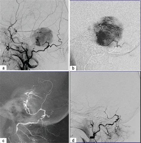 Occipital Artery Occlusion To Facilitate Transmastoid Posterior Fossa Tumor Embolization