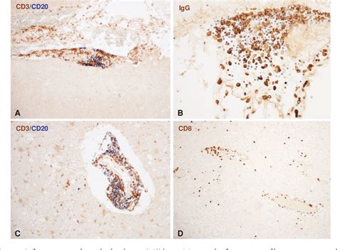 Figure 1 From Multiple Sclerosis Pathology Semantic Scholar