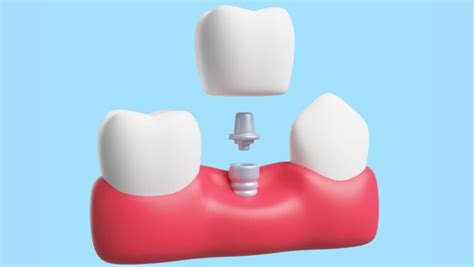 Mini Implante Dentário O Que é E Como Funciona Oraldents