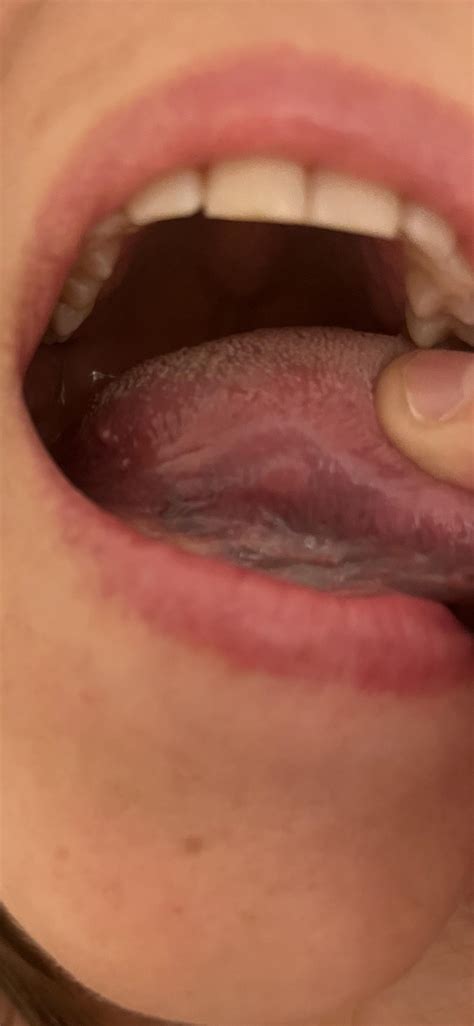 Does This Look Like A Canker Sore I Suffer From Pretty Bad Anxiety And