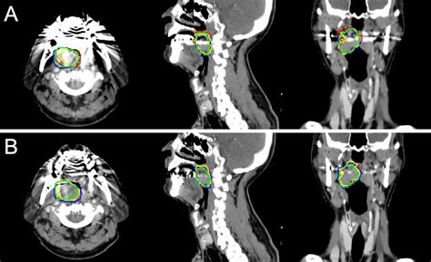 Examples Of Gross Tumor Volume Gtv In Patients With Tonsillar Cancer Download Scientific