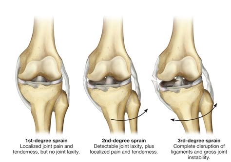 The Most Common Knee Injuries And Disorders Kneesafe Com