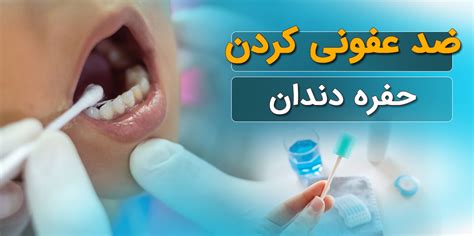 آیا دندان خراب را میشود کامپوزیت کرد؟ عارف کلینیک