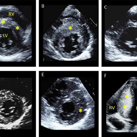 Images From A Patient With Hcm A Asymmetrical Septal Hypertrophy Download Scientific Diagram