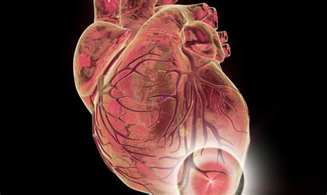 Ecmo Linked With Increased Bleeding Risk Among Patients With Cardiogenic Shock
