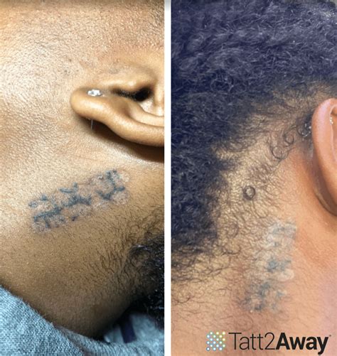 Tattoo Removal Before And After Dark Skin