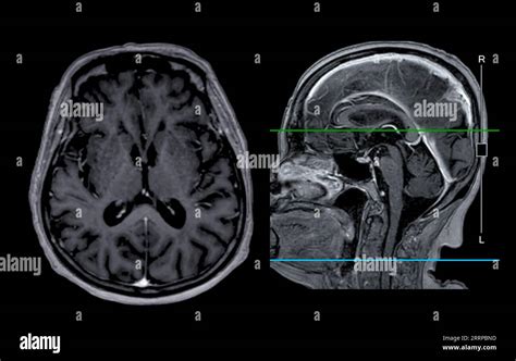 Mri Brain Scan Axial And Sagittal View With Reference Line For Detect