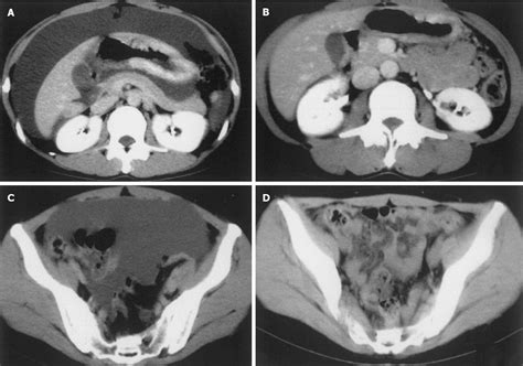 Figure 1 From A Case Of Scirrhous Gastric Cancer With Peritonitis Carcinomatosa Controlled By Ts
