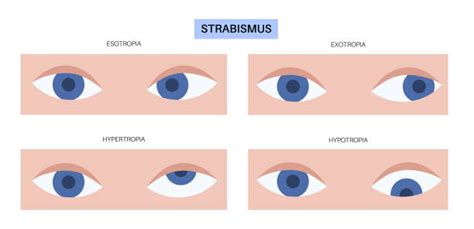 160 Strabismus Stock Illustrations Royalty Free Vector Graphics