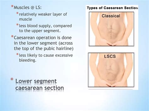 Lower Uterine Segment Ppt