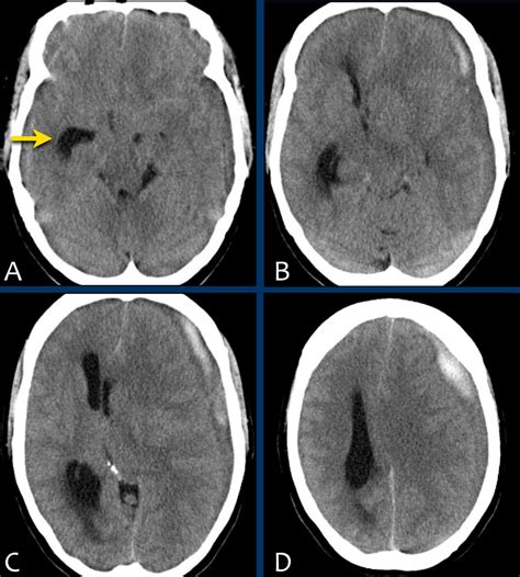 The Radiology Assistant Traumatic Intracranial Hemorrhage