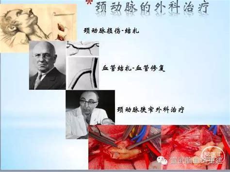 Cea的切口选择 脑医汇