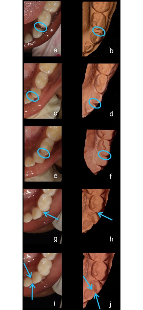 Representative Clinical Images And Their Respective Stone Models For