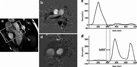Three Dimensional Three Directional Velocity Encoded Mri At The Aorta