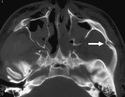 Le Fort Fracture X Ray How To Simplify The Ct Diagnosis Of Le Fort