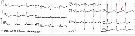 Electrocardiogram Showing Prolongation Of Qt Interval Corrected Qt Download Scientific Diagram