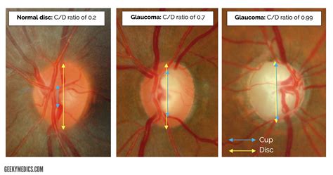 Fundoscopic Appearances Of Retinal Pathologies Geeky Medics