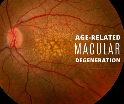 February Is Age Related Macular Degeneration Awareness