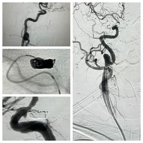 Kalyan Sajja On Linkedin 42 Year Old With Ruptured Pcom Aneurysm Treated With Simple Coiling…